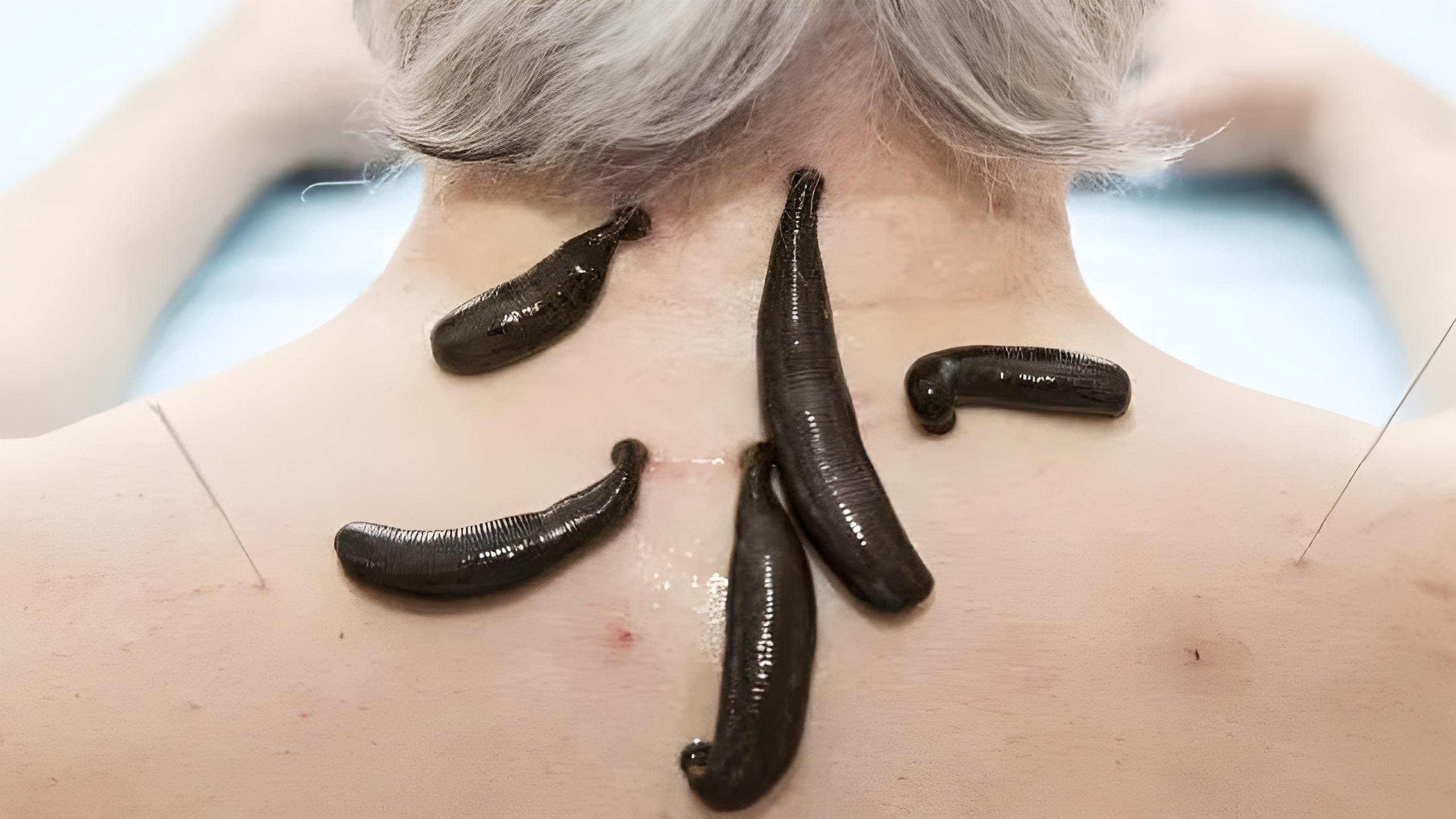 Benefits of Leech Therapy for Fibromyalgia Pain Management - Fibromyalgia Warrior
